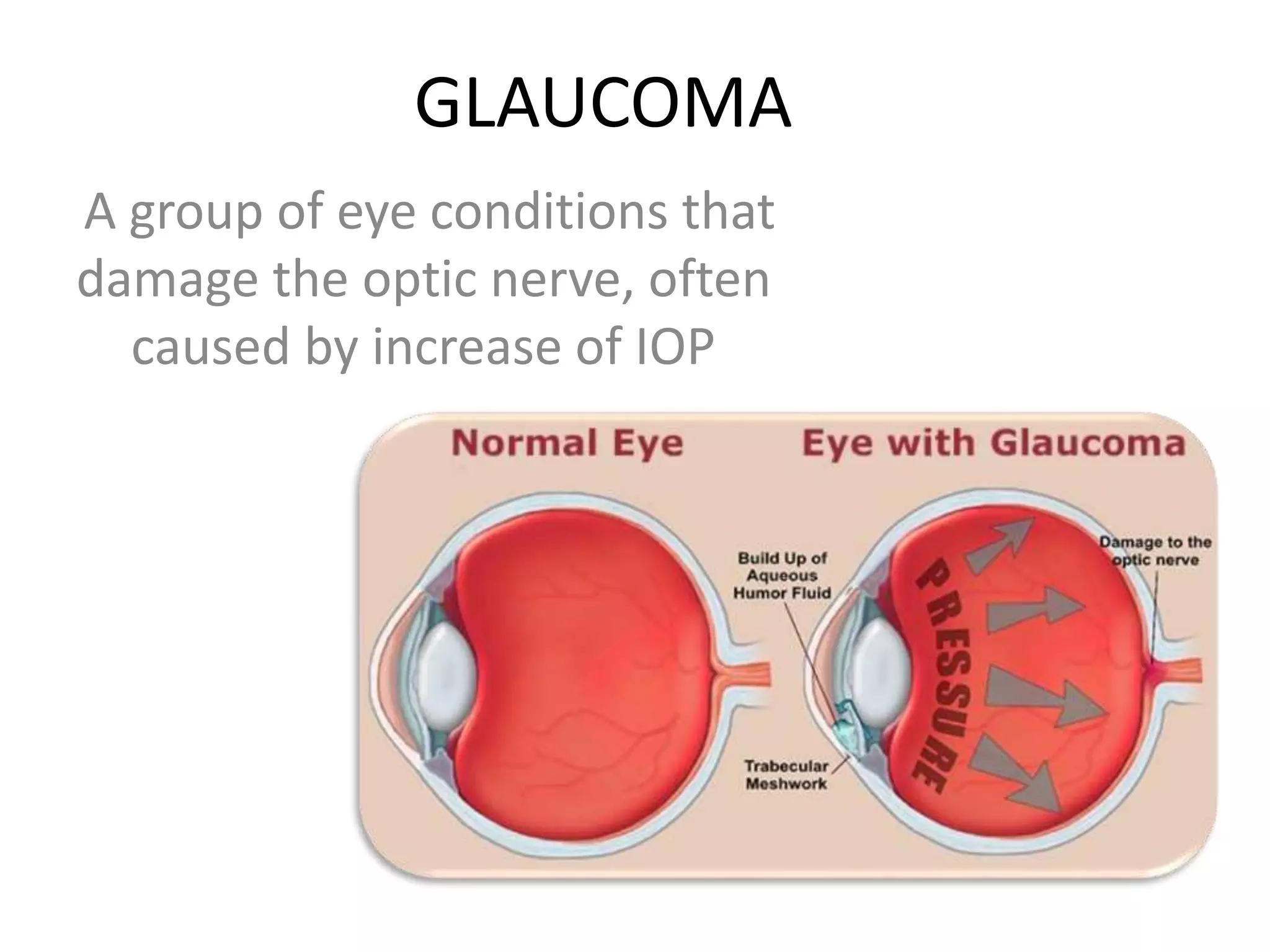 Glaucoma (opthalmology) | PPTX