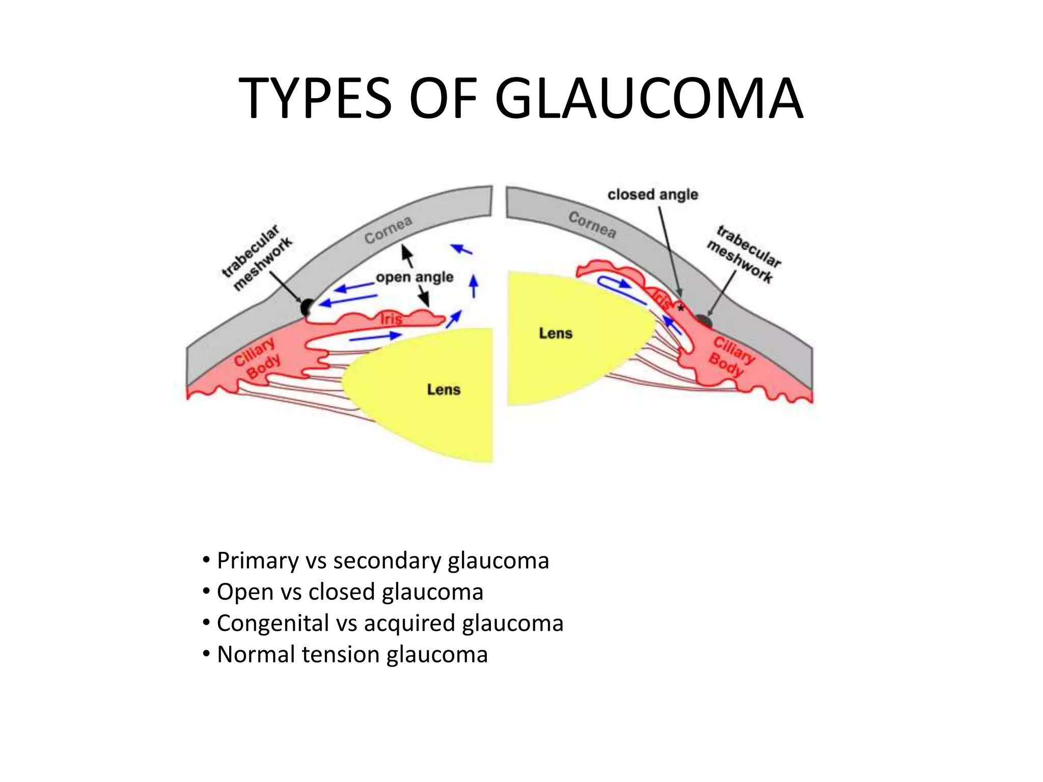Glaucoma (opthalmology) | PPTX