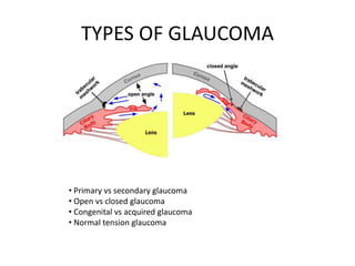 Glaucoma (opthalmology) | PPTX