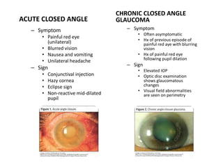 Glaucoma (opthalmology) | PPTX