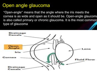 Glaucoma | PPT