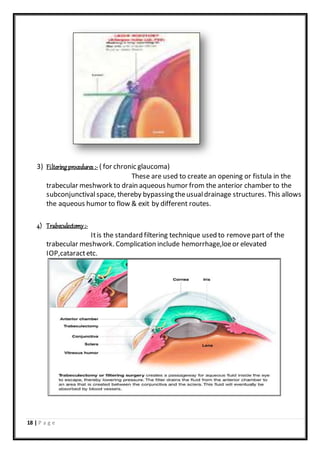 Glaucoma | DOCX
