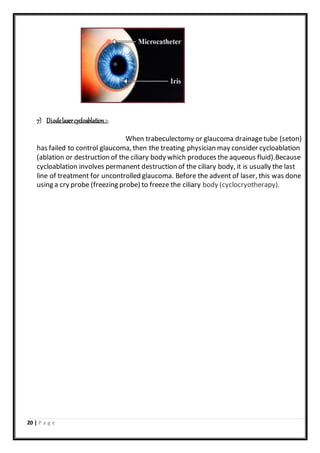 Glaucoma | PDF