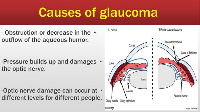 Glaucoma | PPT