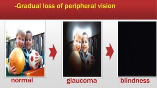 Glaucoma | PPT