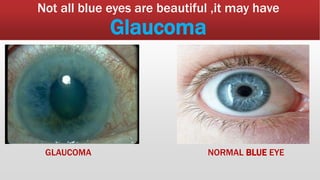 Glaucoma | PPTX