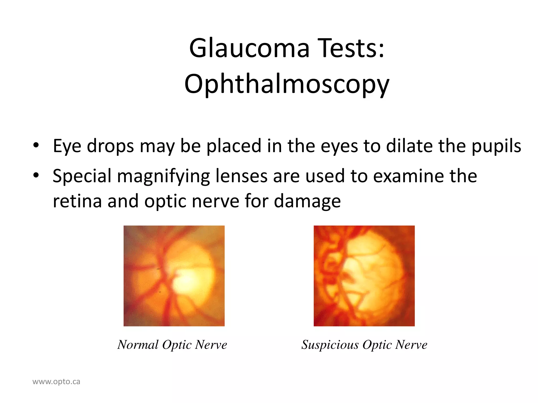 Glaucoma | PDF