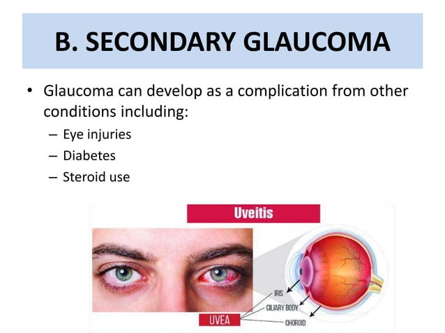 Glaucoma | PDF
