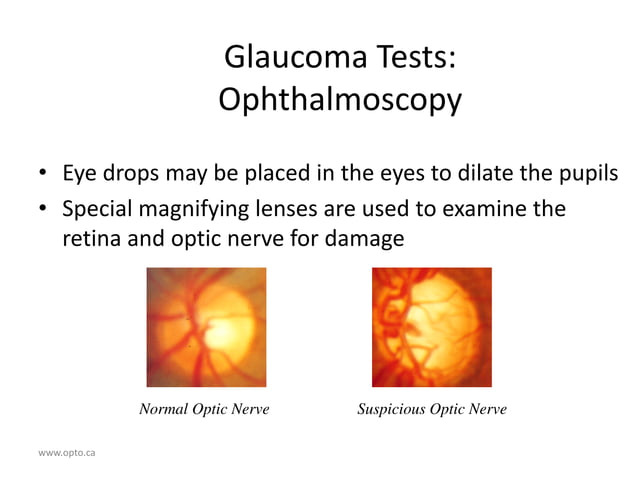Glaucoma | PDF