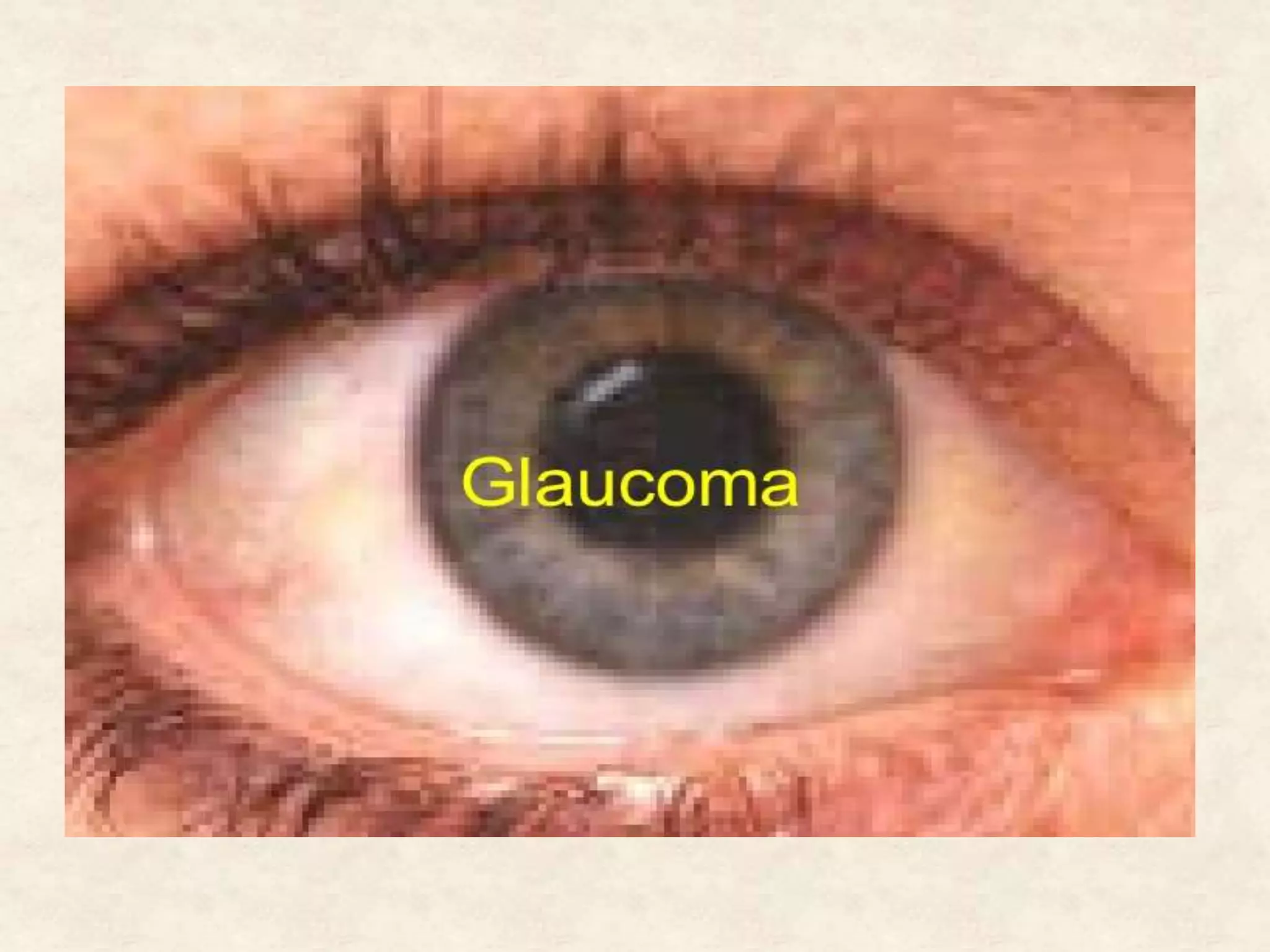 Glaucoma | PPTX