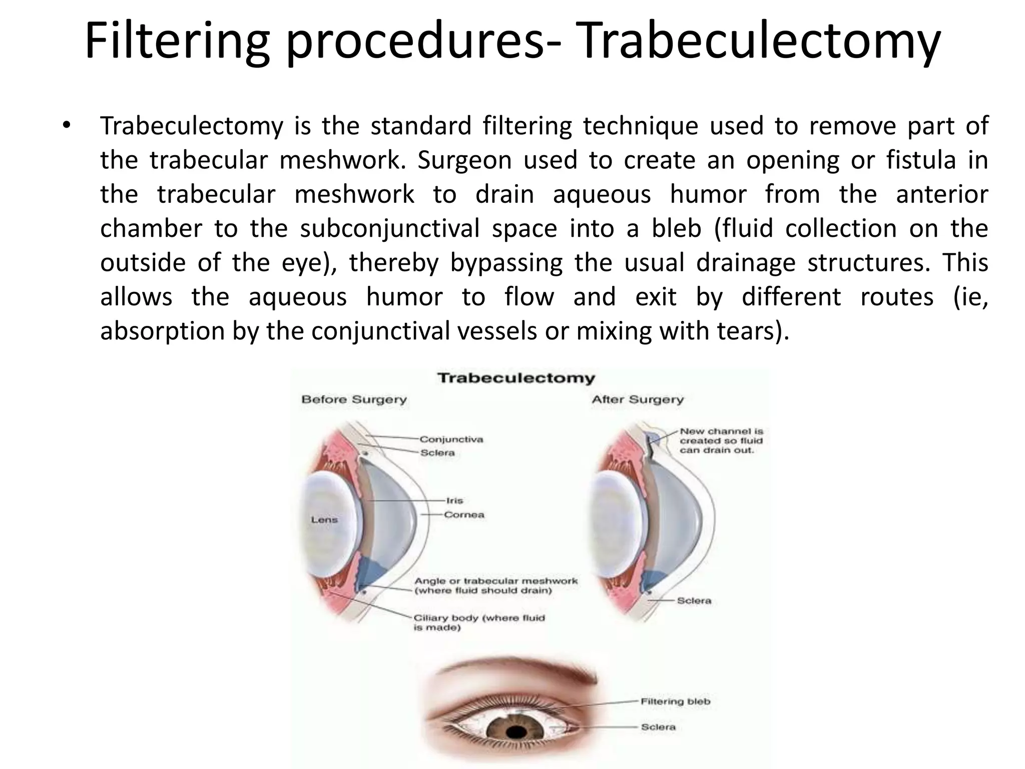 Glaucoma | PPTX
