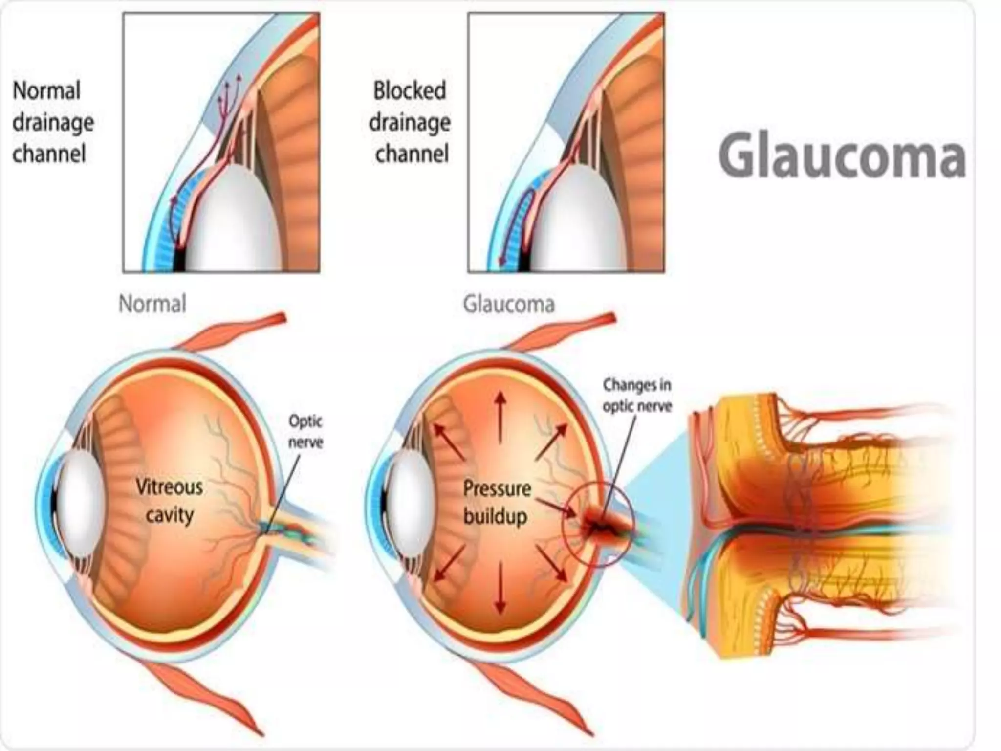 Glaucoma | PPTX