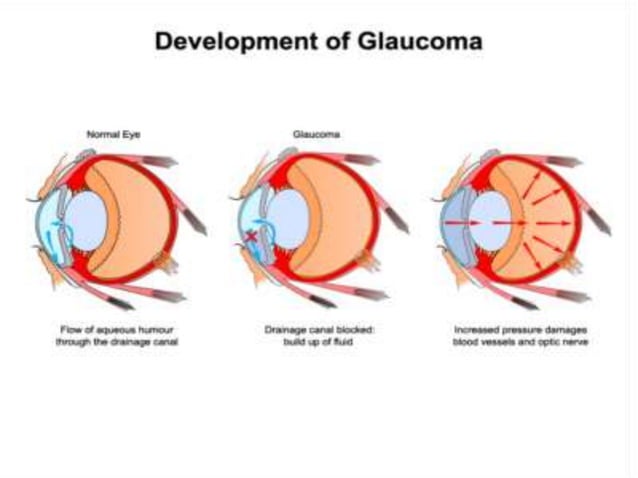 Glaucoma | PPTX