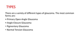 Glaucoma | PPTX
