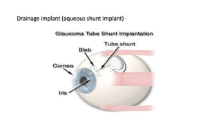 Glaucoma | PPTX