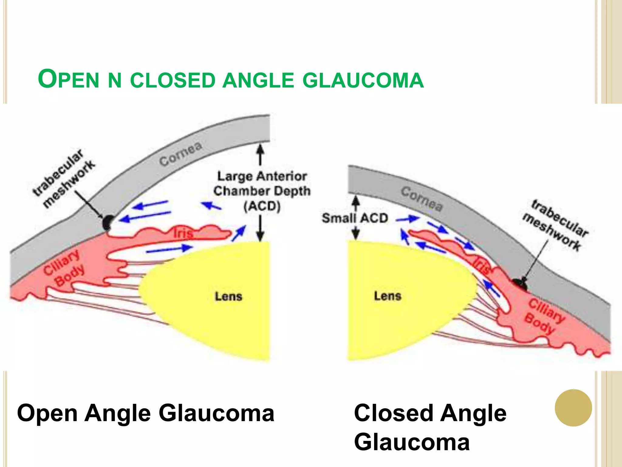 Glaucoma types, Pathogenesis, Diagnosis and Treatment | PPTX
