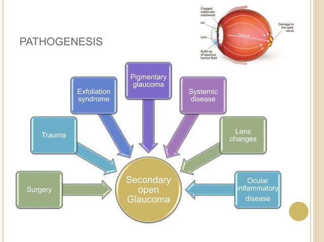 Glaucoma types, Pathogenesis, Diagnosis and Treatment | PPTX