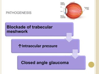 Glaucoma types, Pathogenesis, Diagnosis and Treatment | PPTX