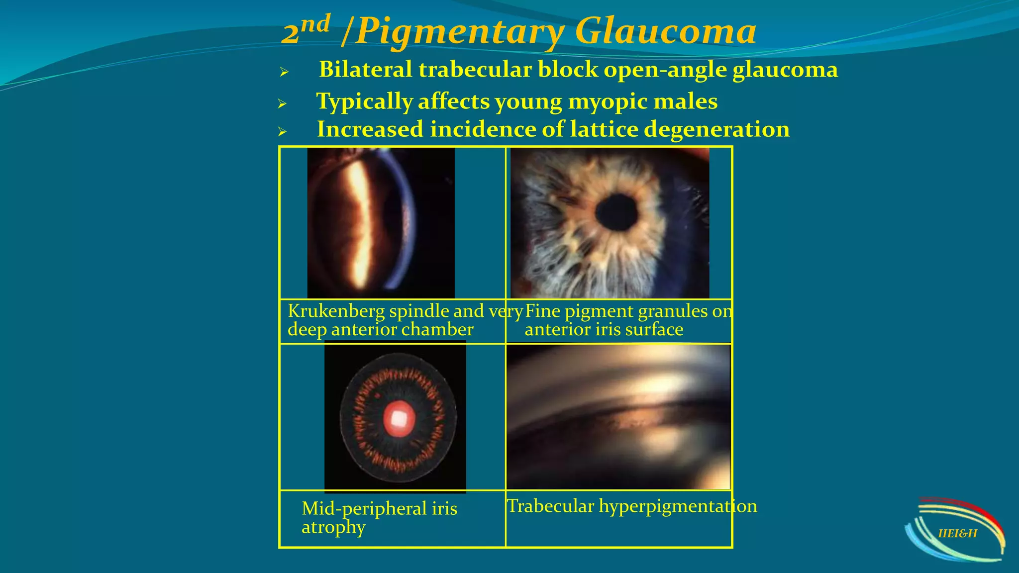 Glaucoma | PPTX