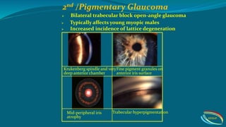 Glaucoma | PPTX