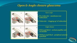 Glaucoma | PPTX