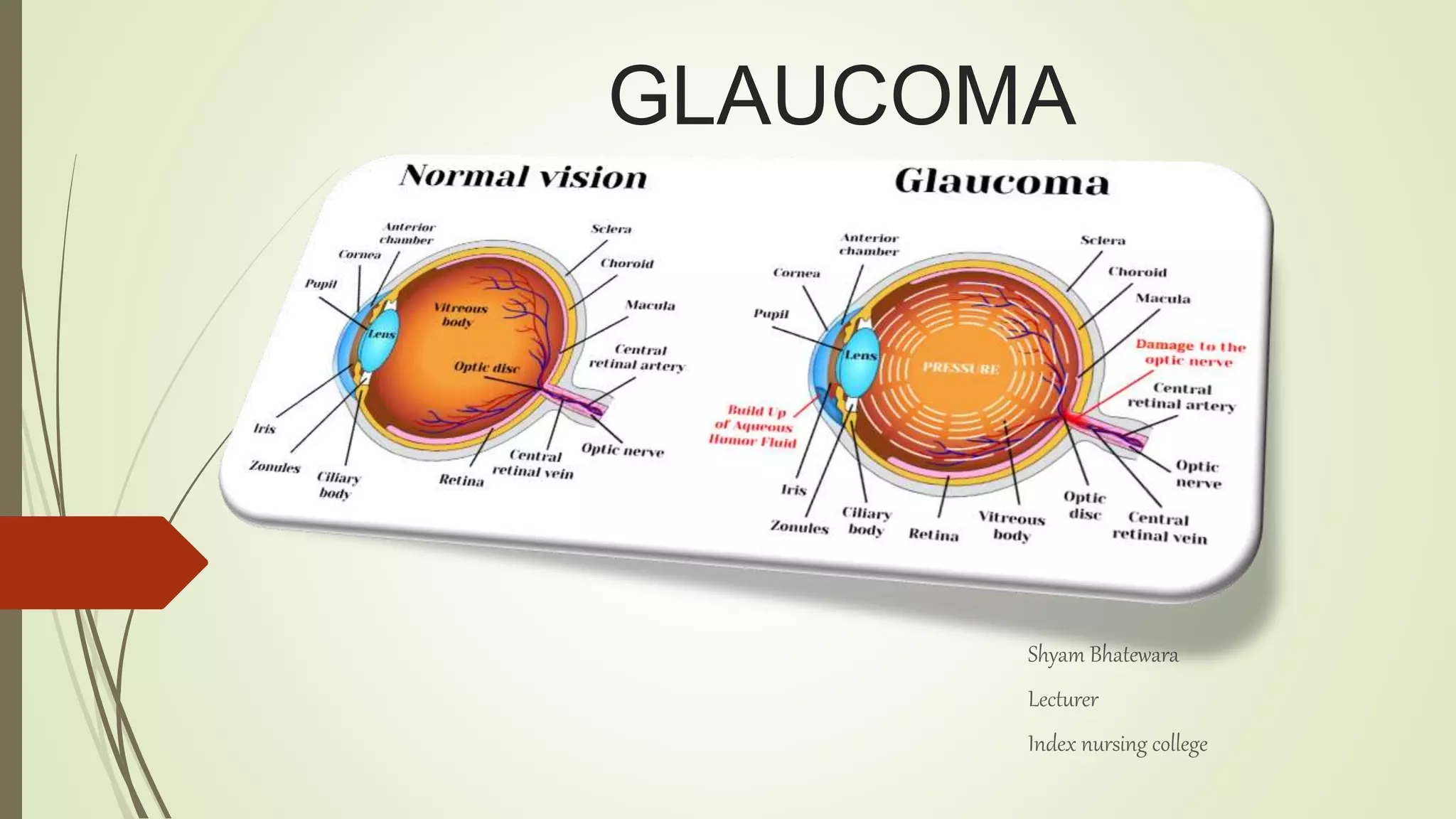 Glaucoma | PPTX