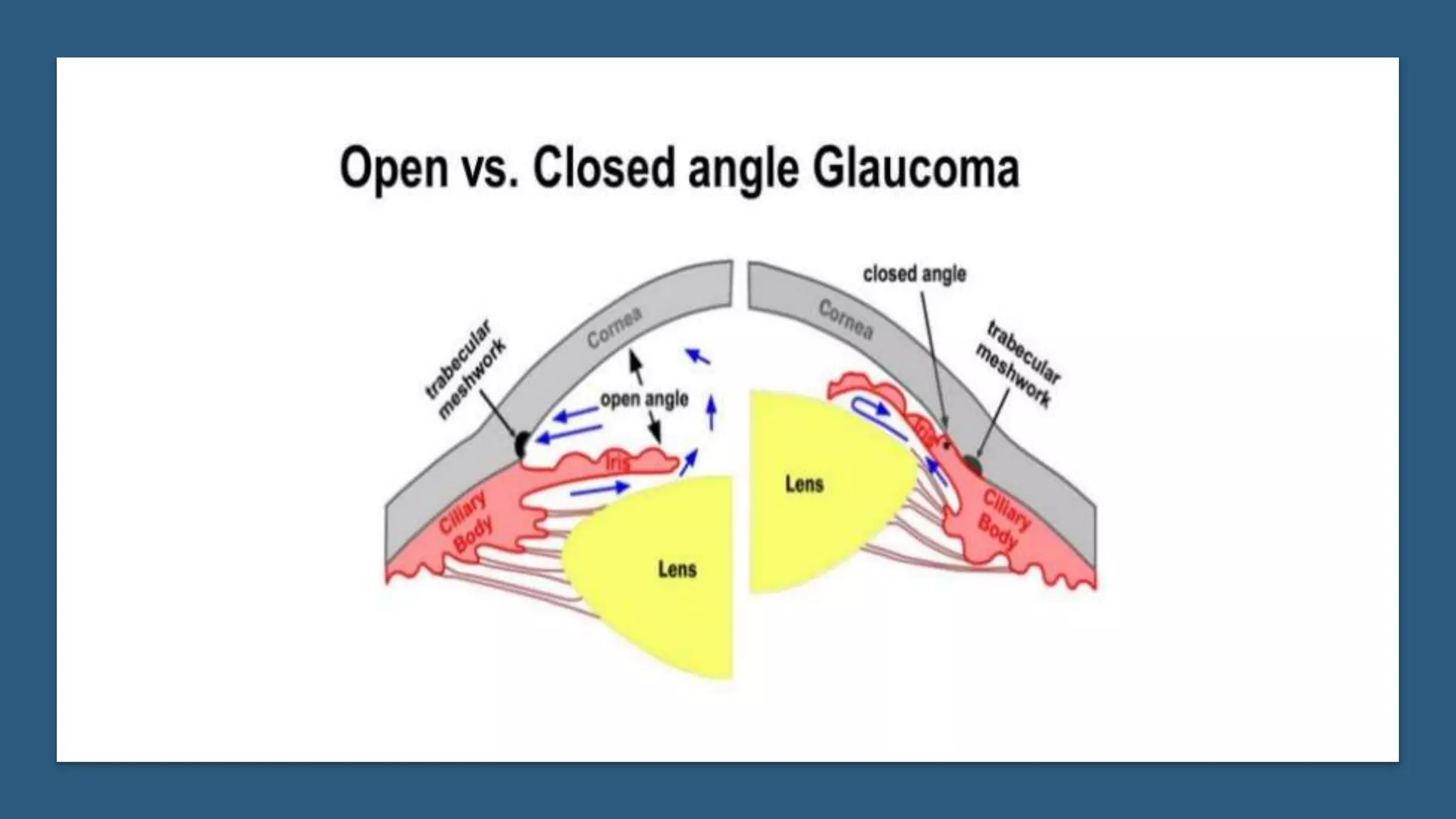 Glaucoma slideshare for medical students | PPTX