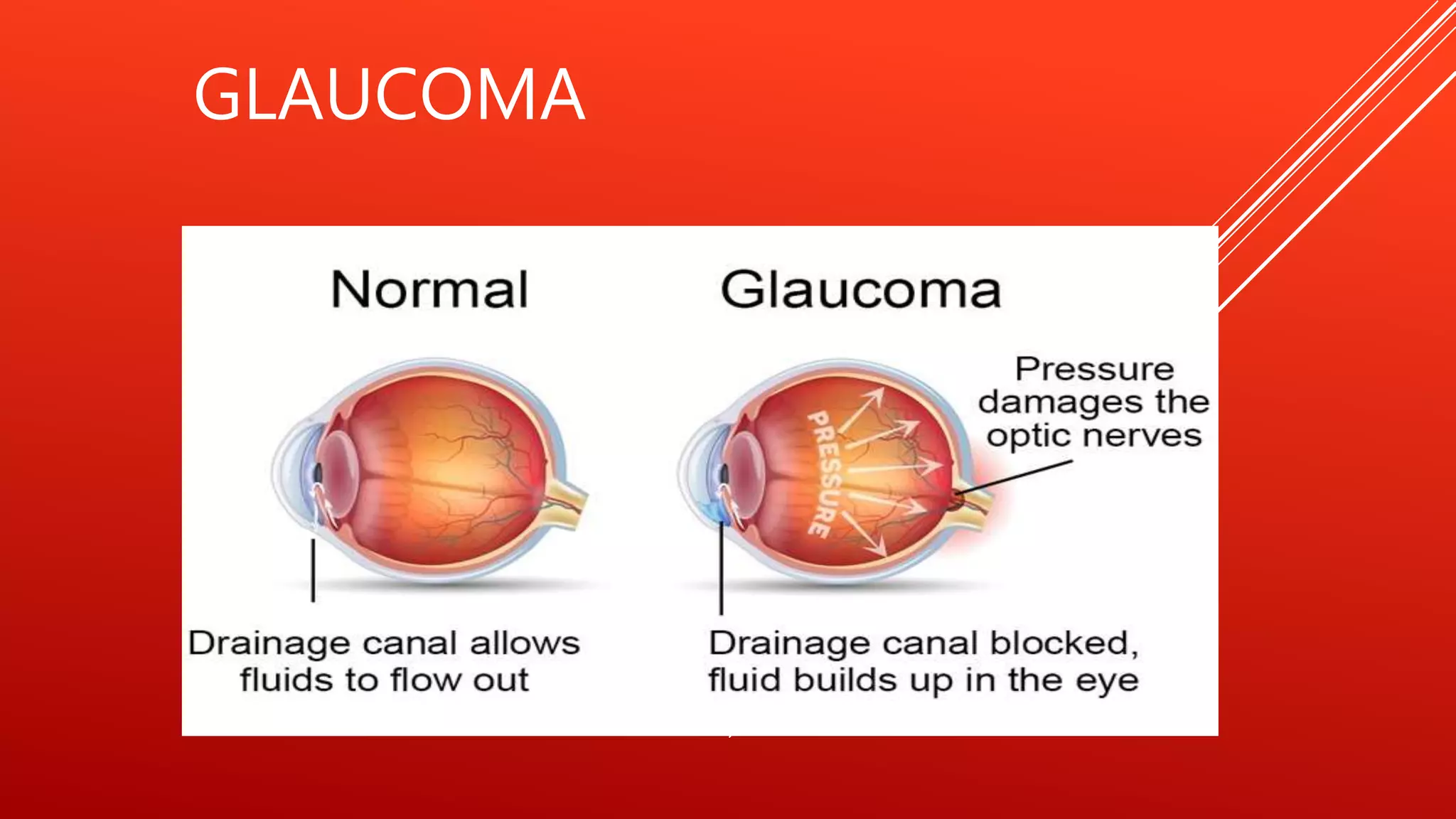 Glaucoma | PPTX