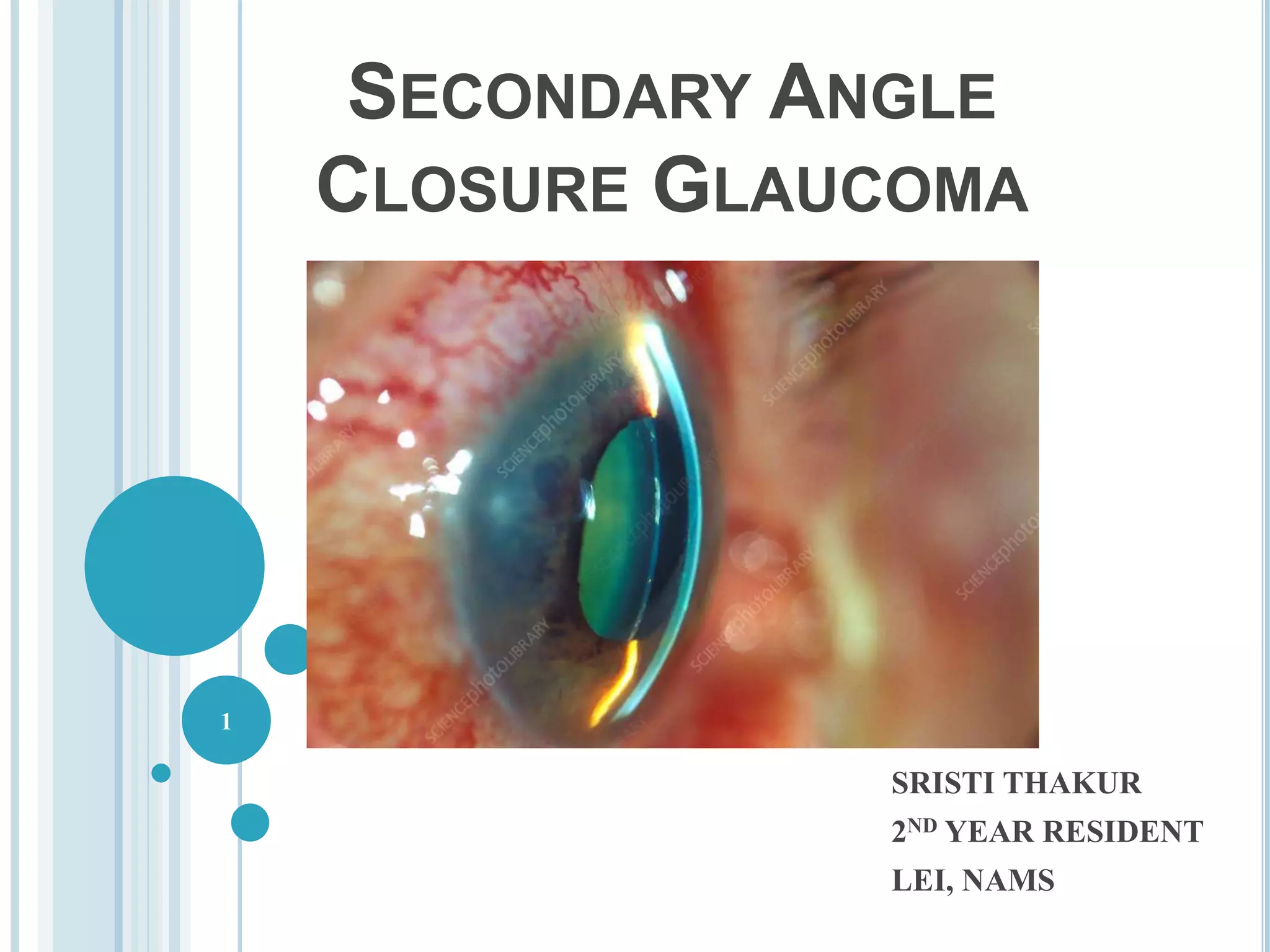 secondary angle closure glaucoma | PPTX