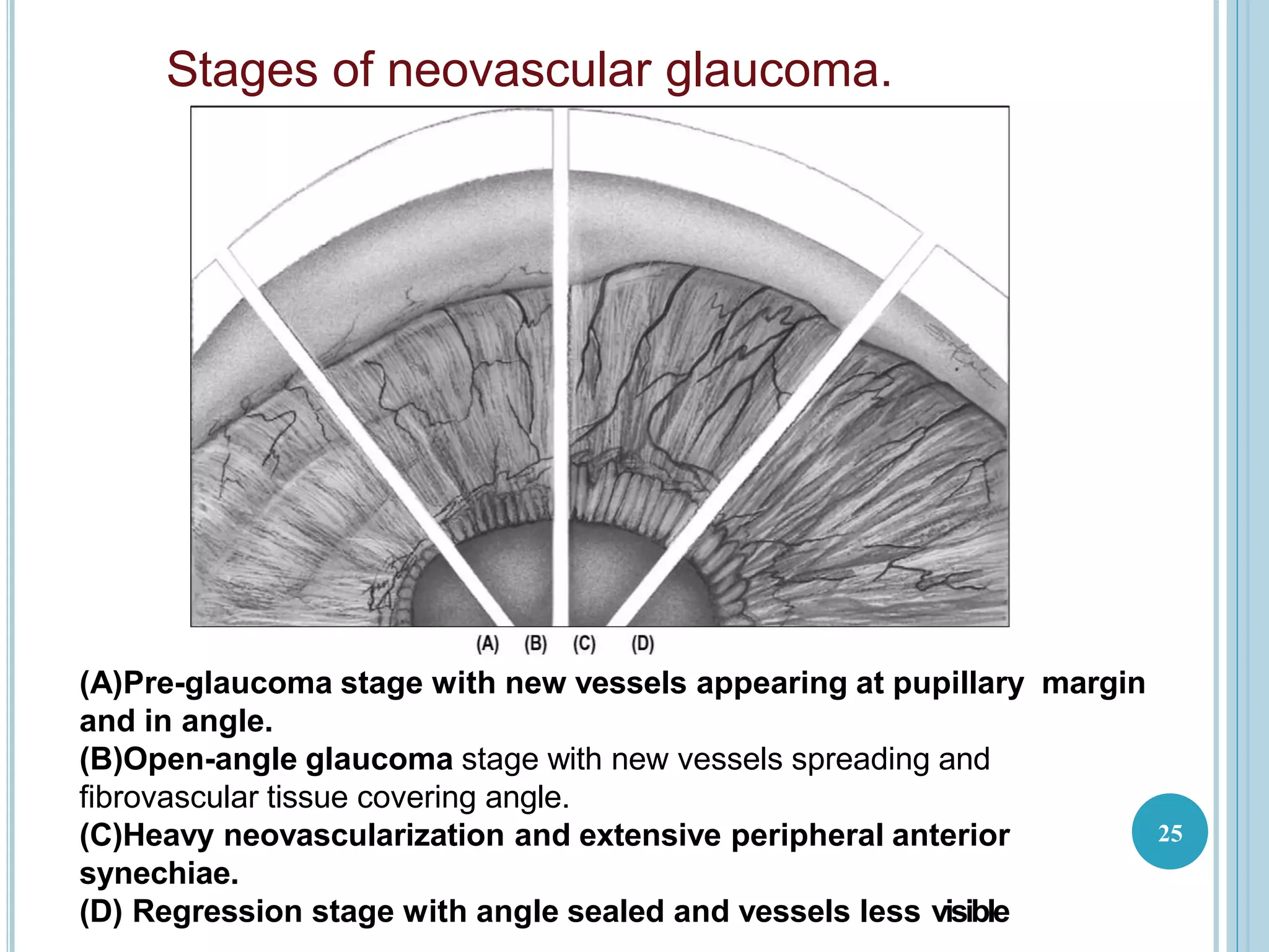 secondary angle closure glaucoma | PPTX