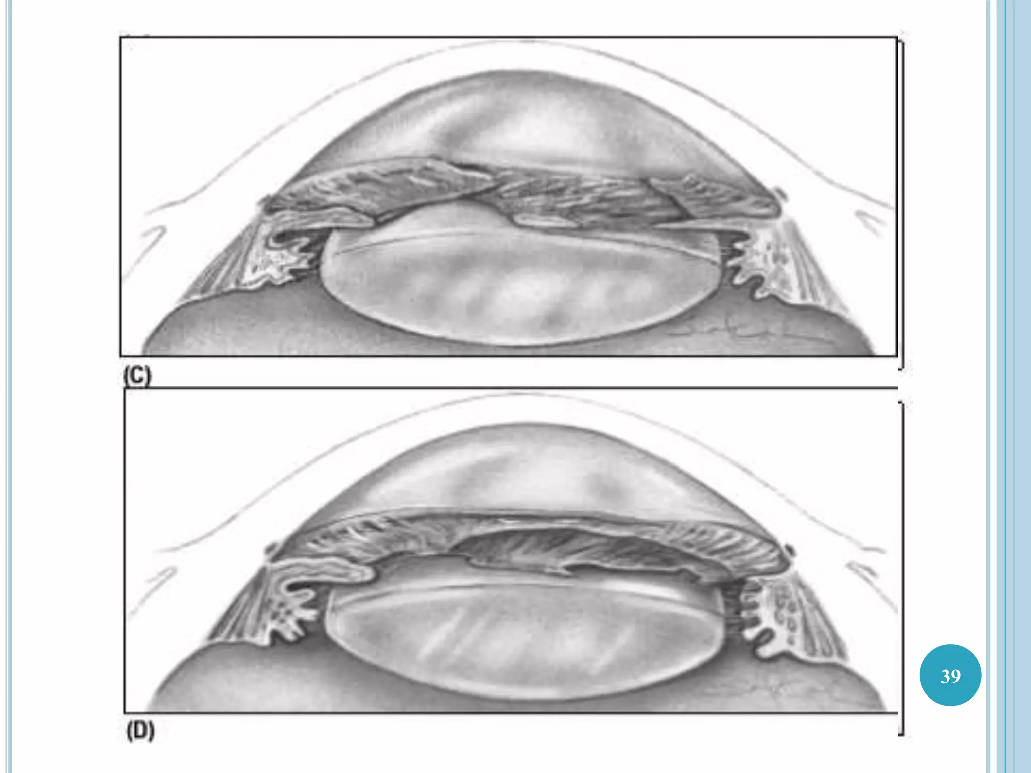 secondary angle closure glaucoma | PPTX
