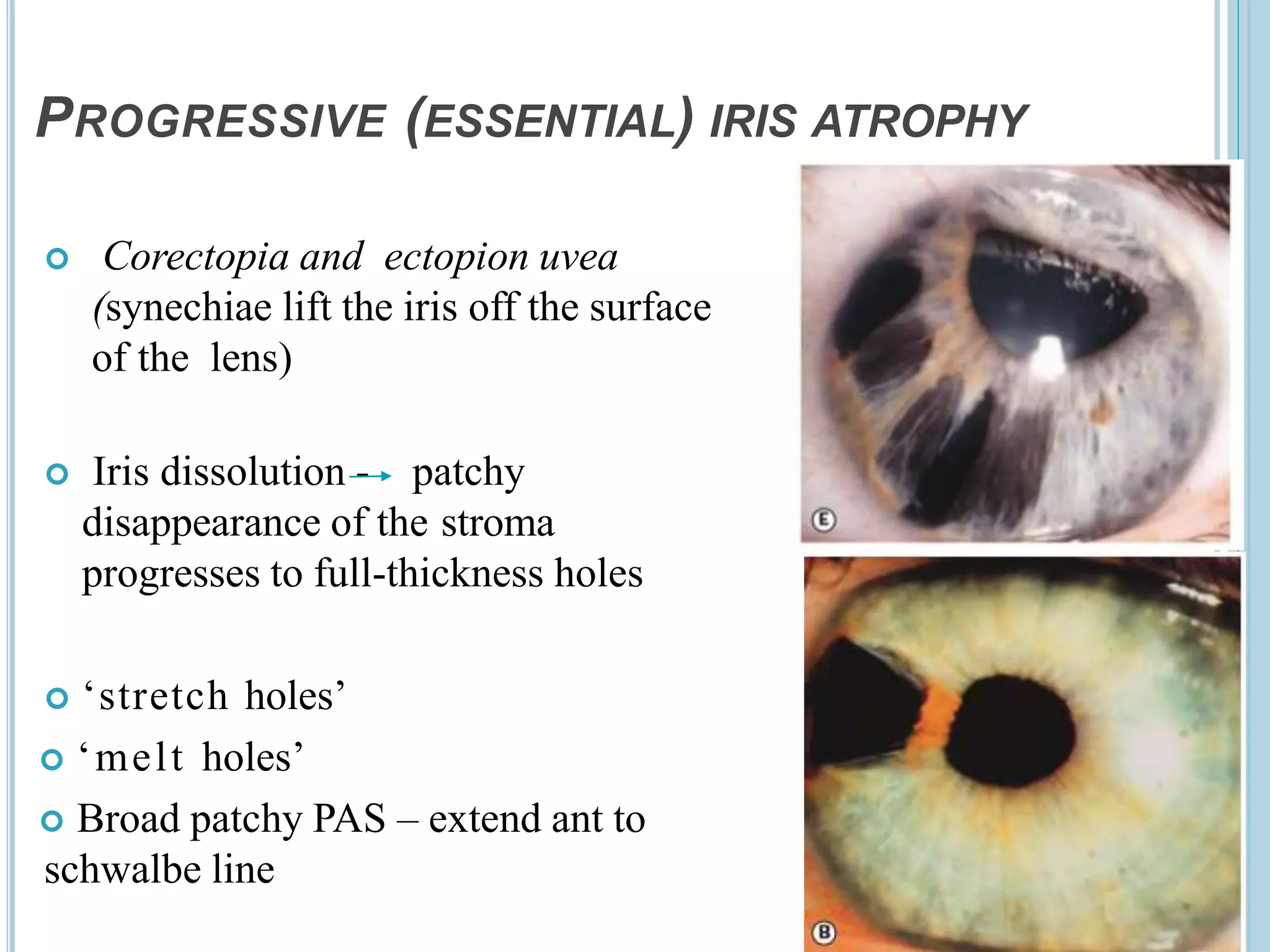 secondary angle closure glaucoma | PPTX