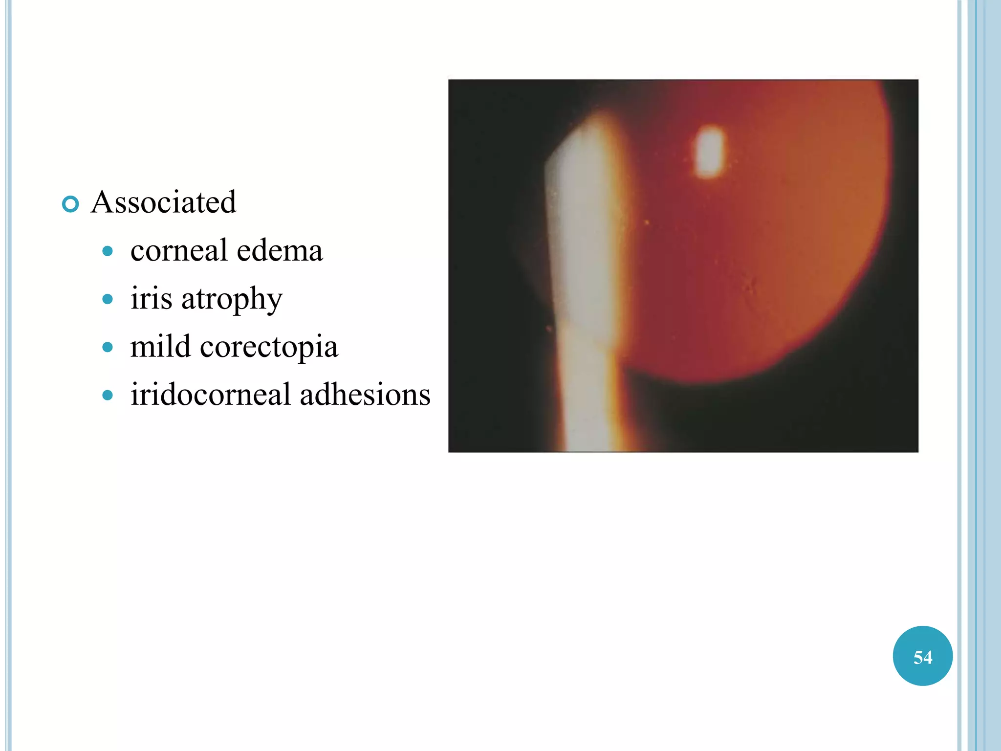 secondary angle closure glaucoma | PPTX