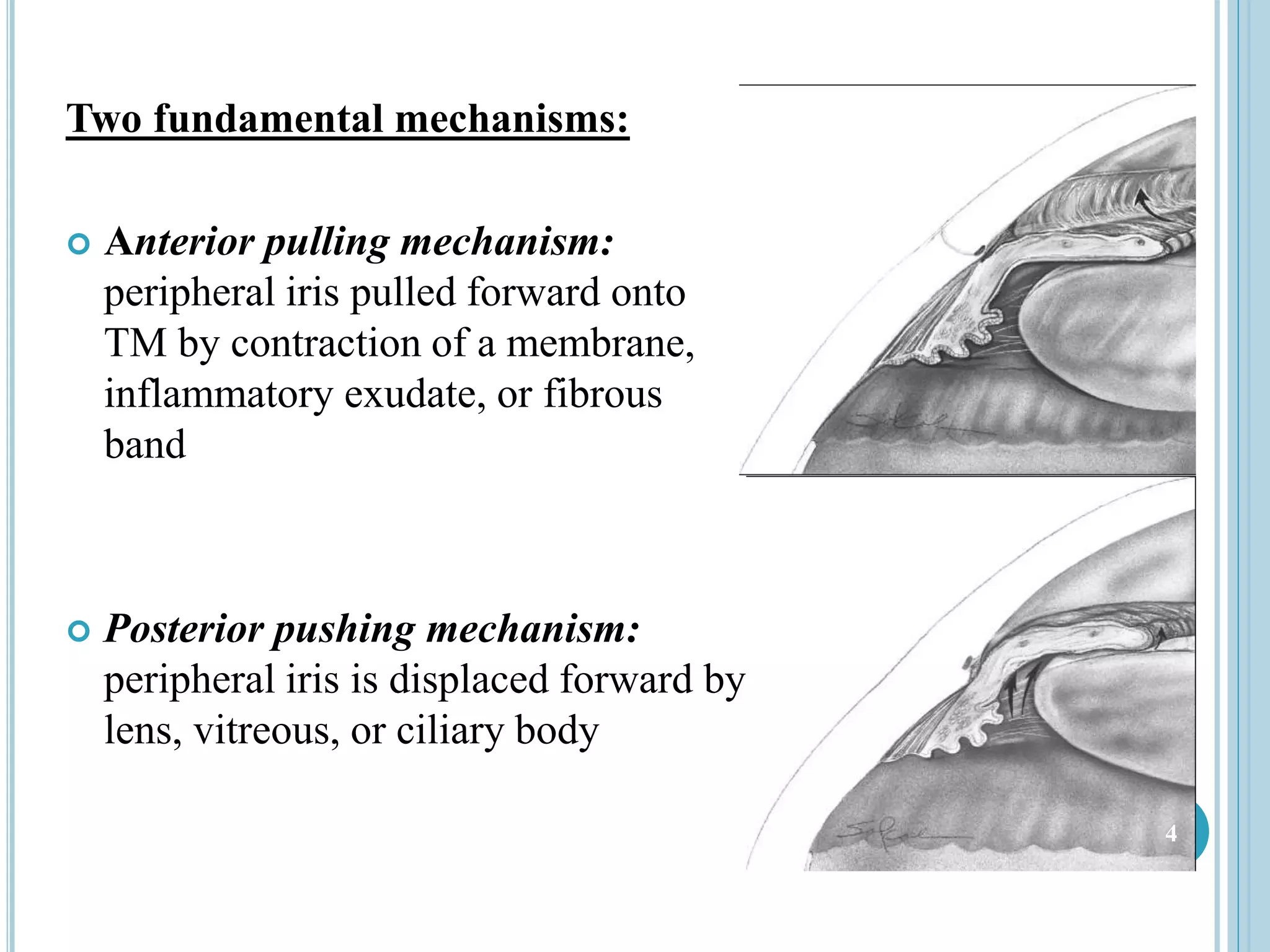 secondary angle closure glaucoma | PPTX