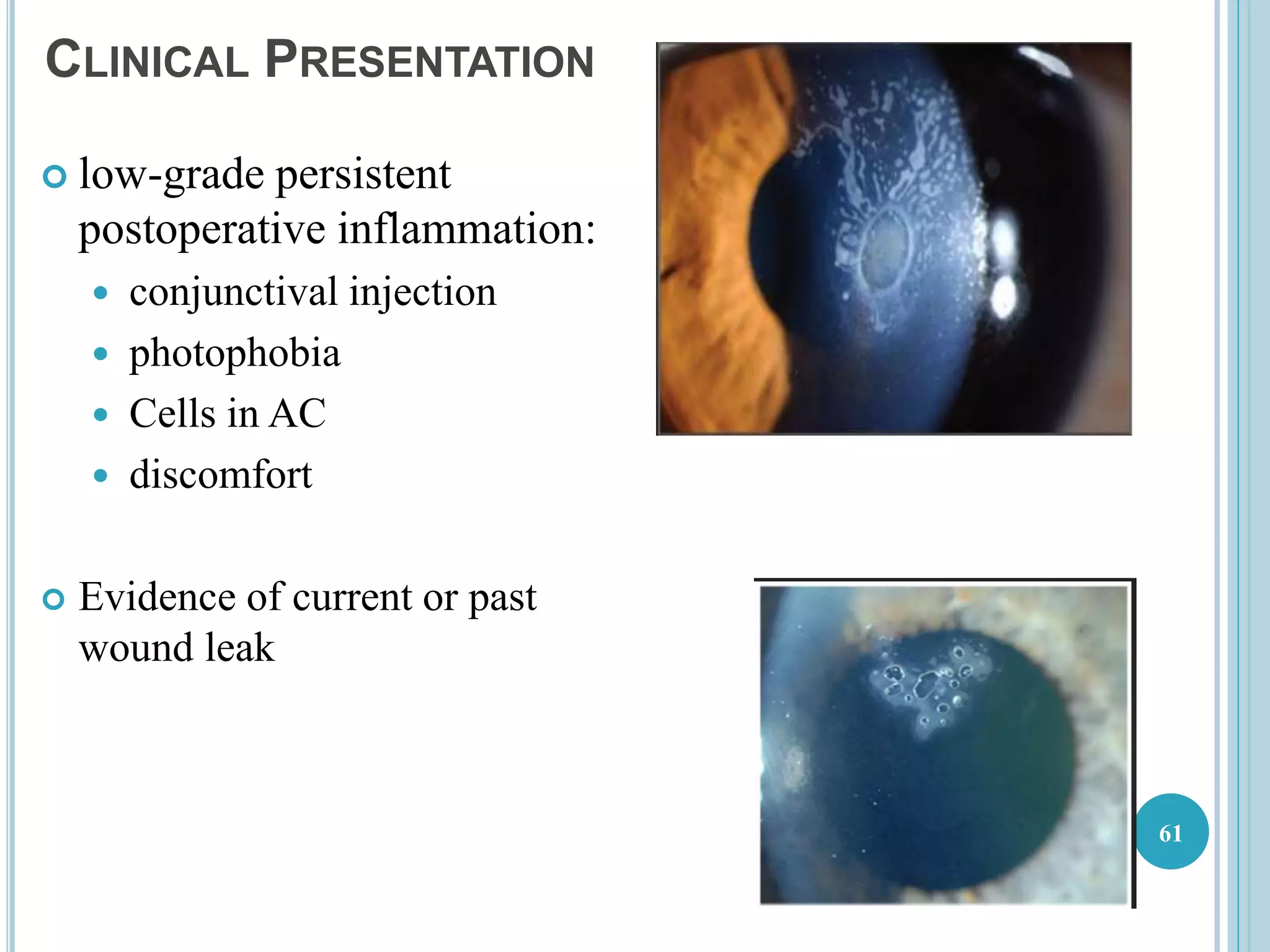 secondary angle closure glaucoma | PPTX