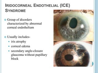 secondary angle closure glaucoma | PPTX