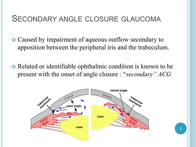 secondary angle closure glaucoma | PPTX