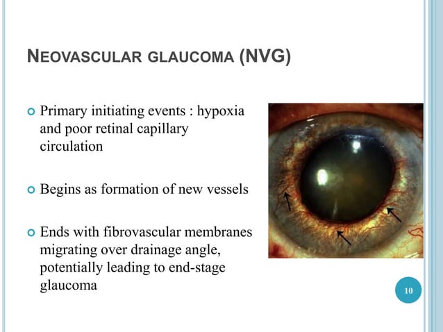 secondary angle closure glaucoma | PPTX