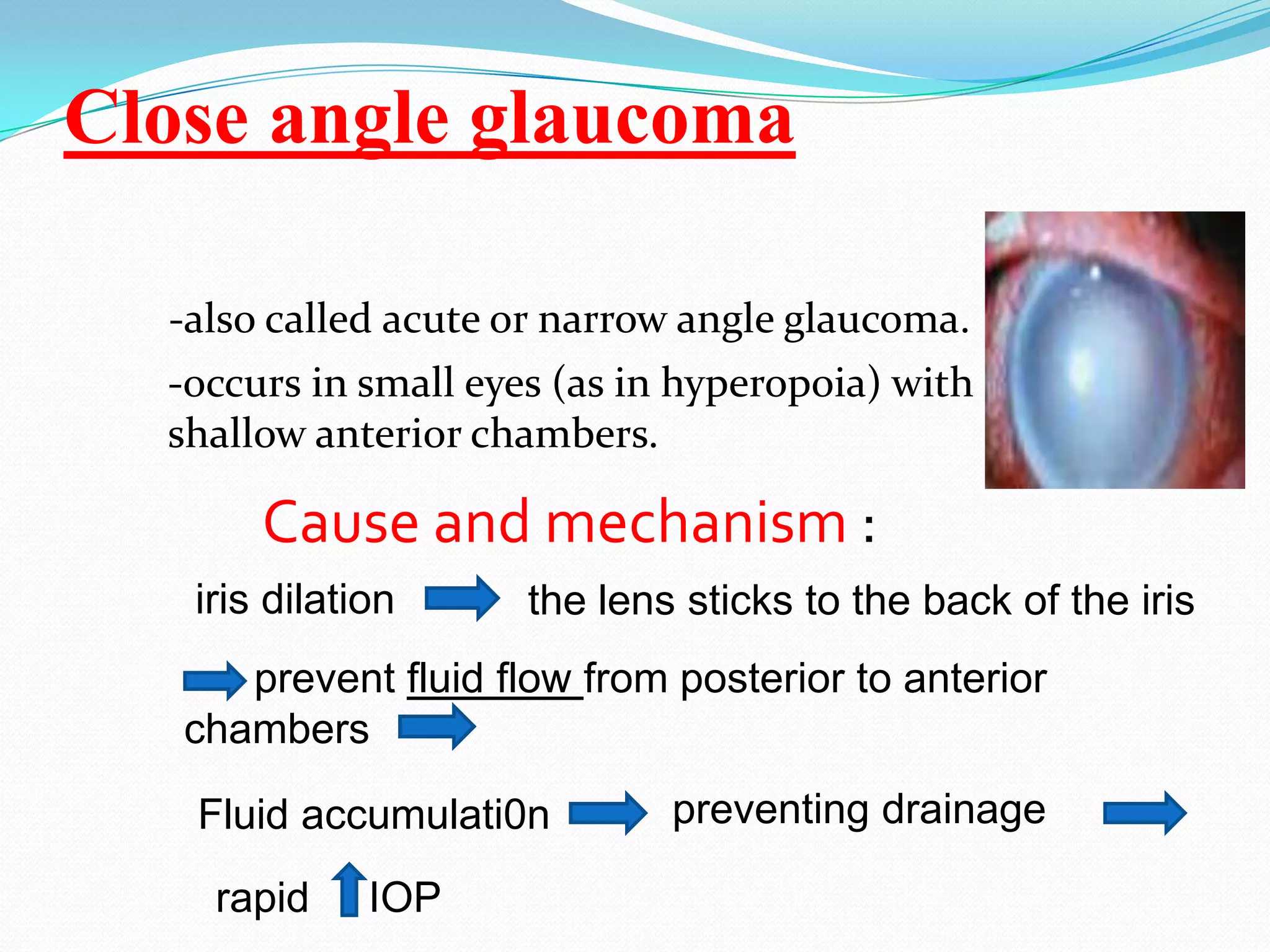 Glaucoma | PPTX