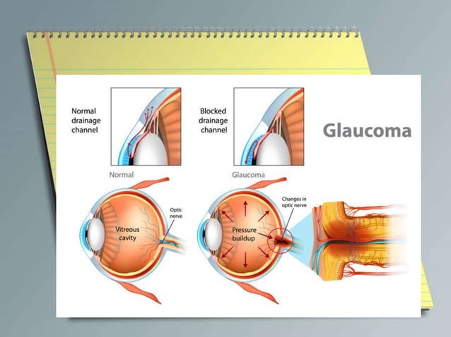 Glaucoma | PPT