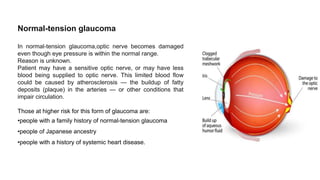 Glaucoma - DISEASE PRESENTATION | PPT