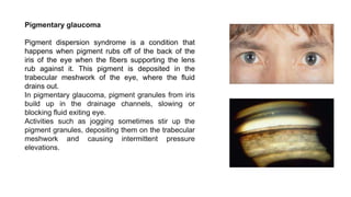 Glaucoma - DISEASE PRESENTATION | PPTX