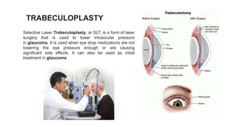 Glaucoma - DISEASE PRESENTATION | PPT