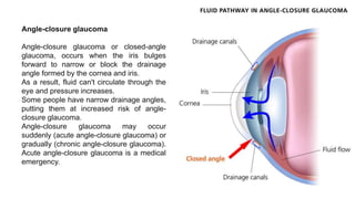 Glaucoma - DISEASE PRESENTATION | PPTX