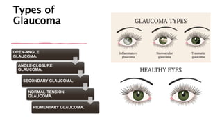Glaucoma | PPT