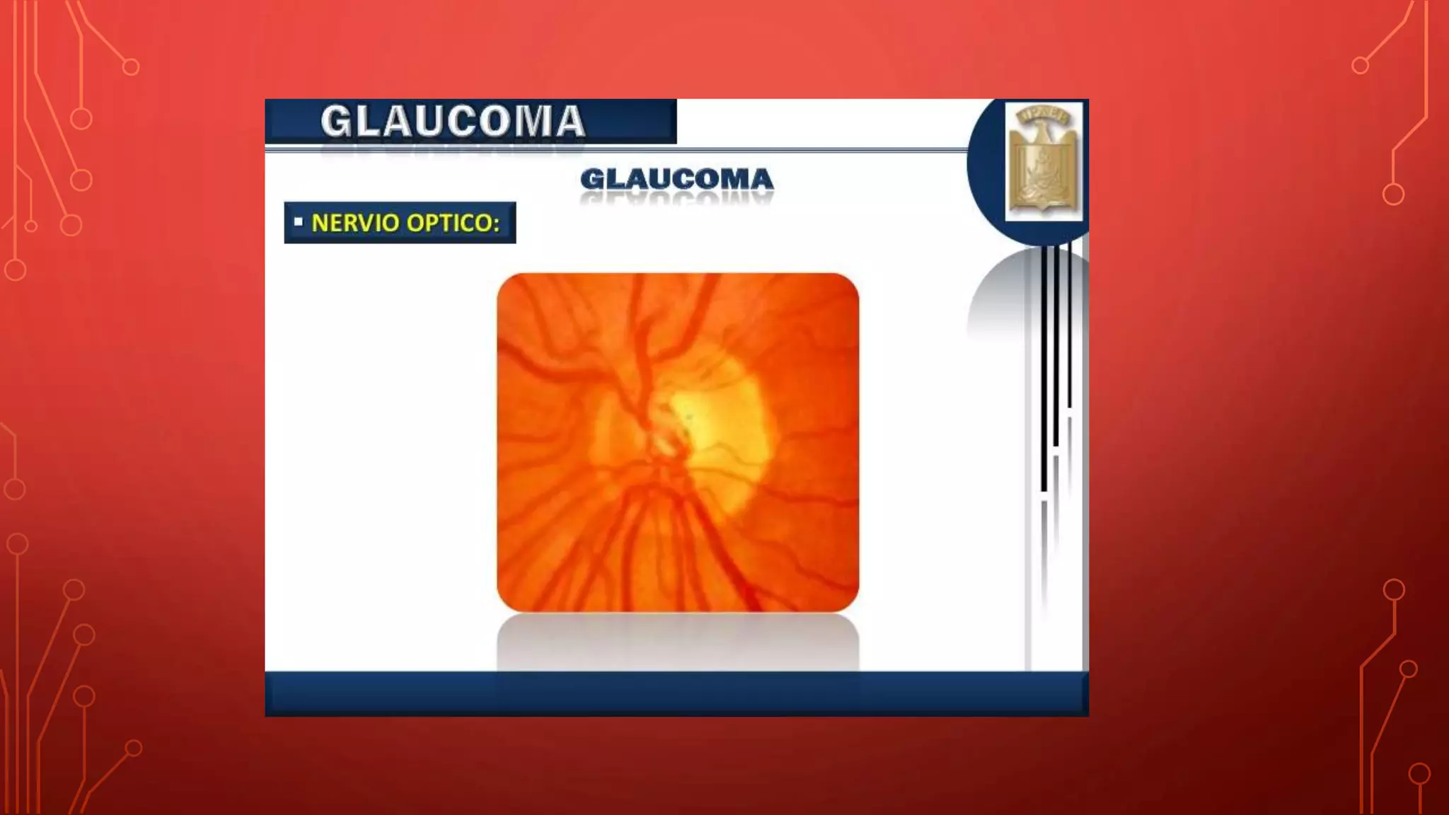 Glaucoma | PPT
