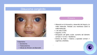 GLAUCOMA.pptx