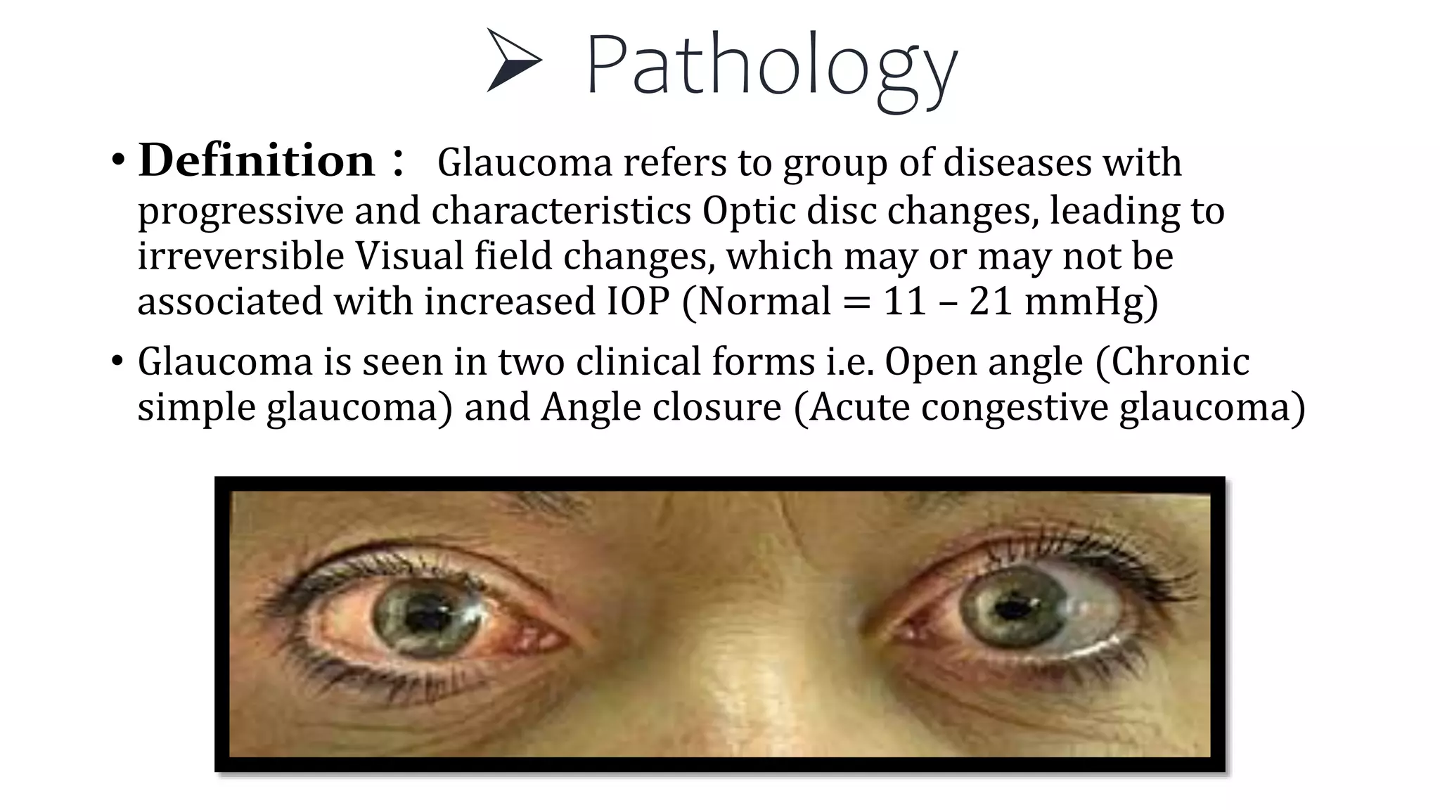 Glaucoma.pptx