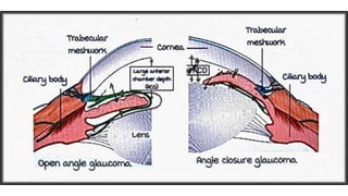 Glaucoma.pptx