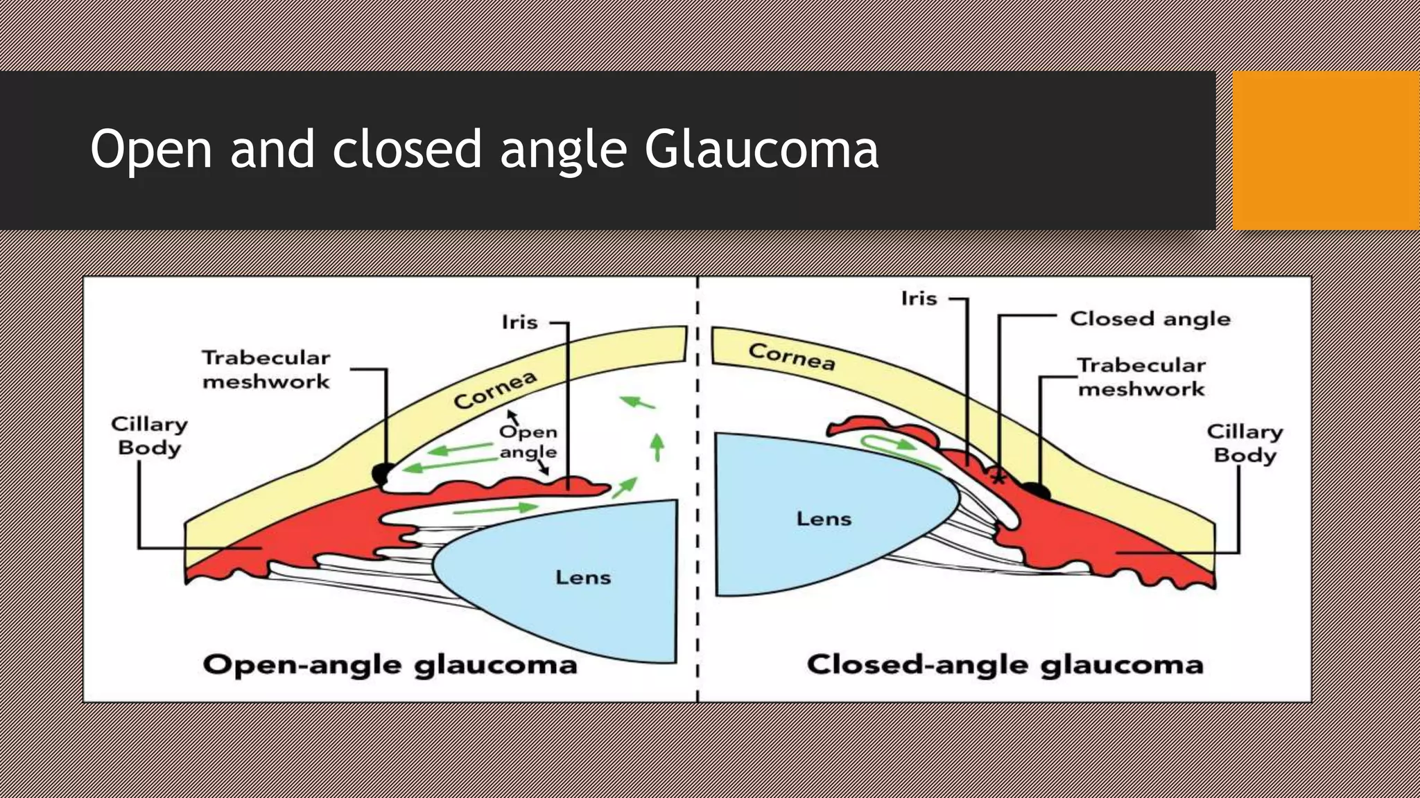 Glaucoma.pptx